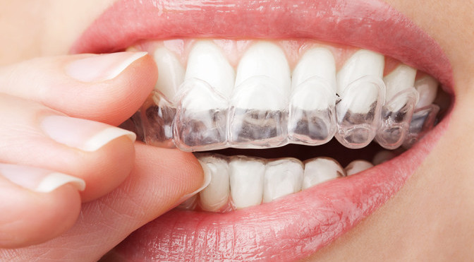 Ways To Get Straight Teeth | Penn Dental Family Practice